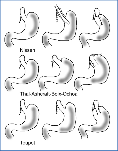 Gastroesophageal Reflux | SpringerLink