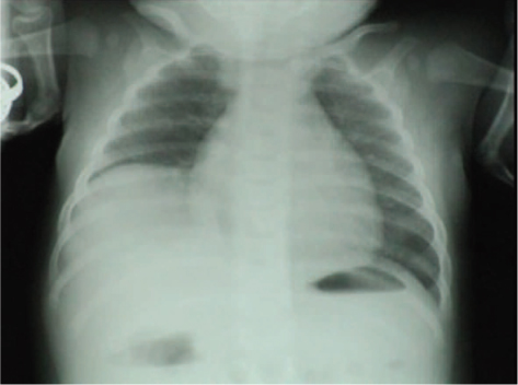 Diaphragmatic Eventration | SpringerLink