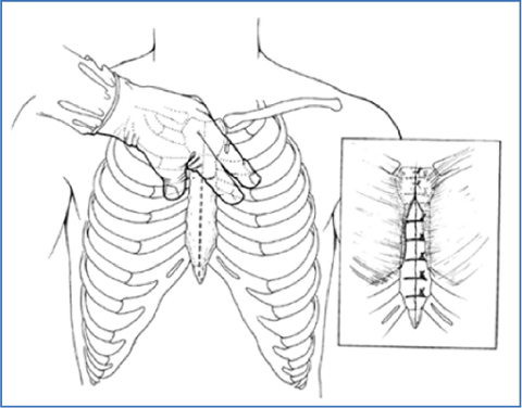 Operative Approaches to the Thorax | SpringerLink