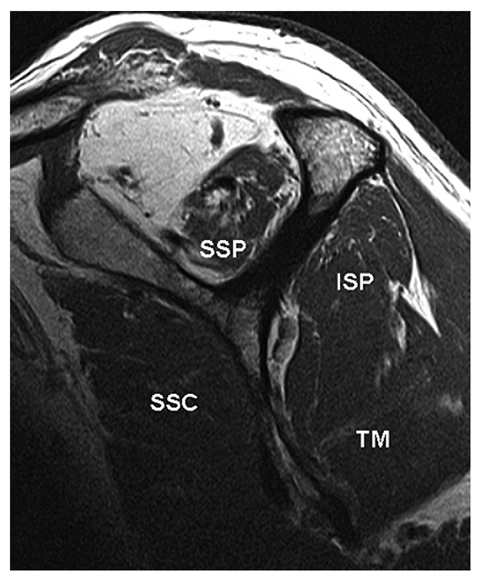 Shoulder: Rotator Cuff and Impingement Syndromes | SpringerLink