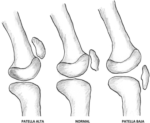 Knee Extensor Mechanism Injuries | SpringerLink