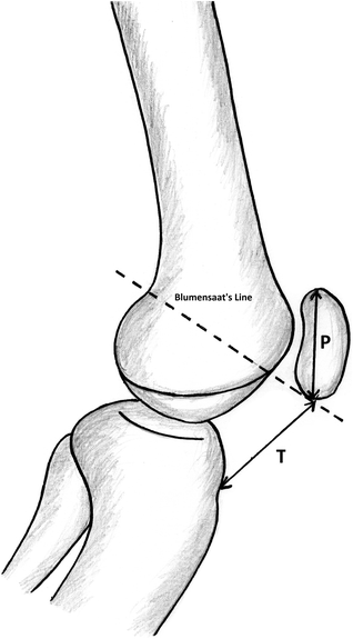 Knee Extensor Mechanism Injuries | SpringerLink
