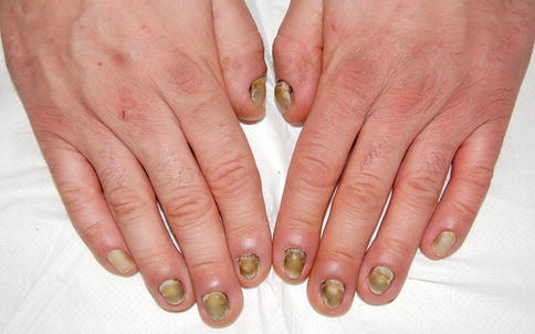 Nail Signs of Systemic Diseases and Drug-Induced Nail Changes ...