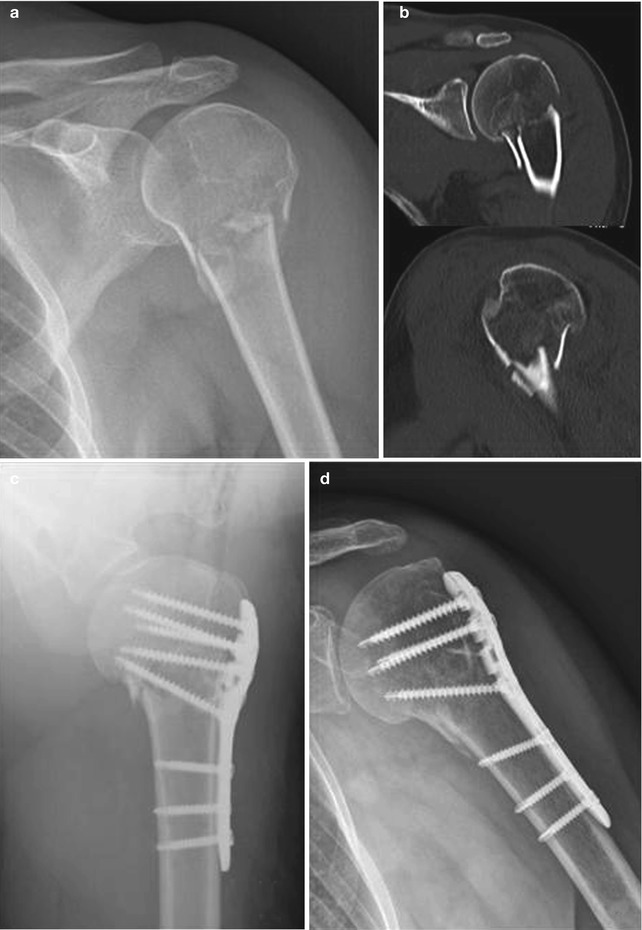 Surgical Neck Fracture | SpringerLink