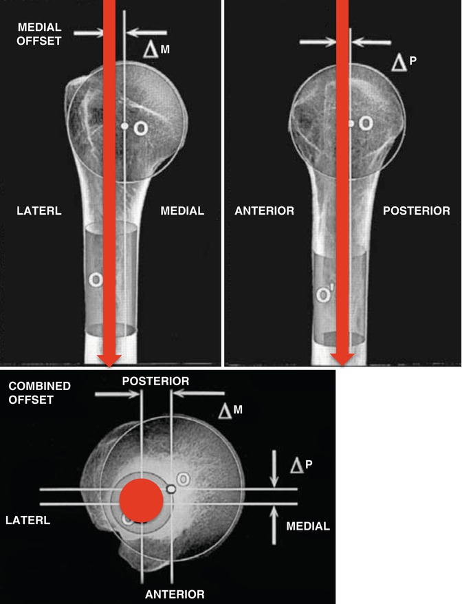 Intramedullary Nail for Proximal Humerus Fractures: An Old Concept ...