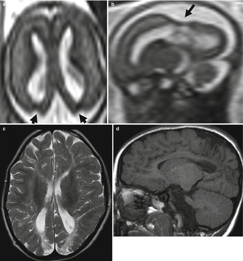 Focal and Multifocal Ischemic/Hemorrhagic Lesions | SpringerLink