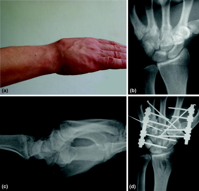 Carpometacarpal (CMC) Dislocations or Fractures-Dislocations Excluding ...