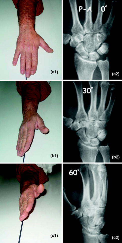 Carpometacarpal (CMC) Dislocations or Fractures-Dislocations Excluding ...