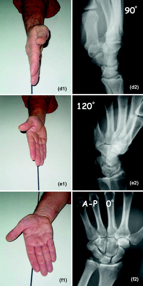 Carpometacarpal (CMC) Dislocations or Fractures-Dislocations Excluding ...
