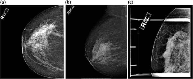Mammographic Diagnosis of Breast Cancer | SpringerLink