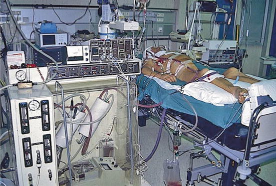 History of Extracorporeal Life Support | SpringerLink