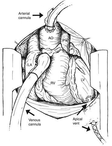 Surgical Cannulation: Indication, Technique, and Complications ...