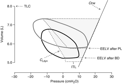 Static and Dynamic Hyperinflation in Chronic Obstructive Pulmonary ...