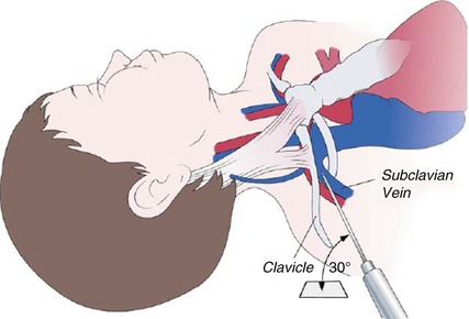 The Usual Vascular Access | SpringerLink