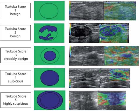 Recent Developments in Breast Ultrasound with a Special Focus on Shear ...