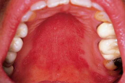 Aandoeningen van mond en lippen | SpringerLink