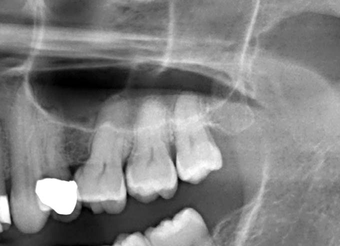 Afwijkingen van de sinus maxillaris | SpringerLink