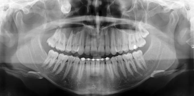 Afwijkingen van de sinus maxillaris | SpringerLink