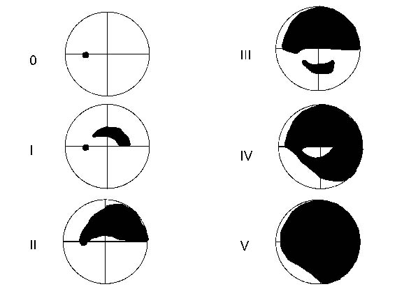 11 Glaucoom | SpringerLink