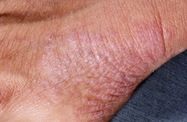 Efflorescenties: de elementen waaruit huidaandoeningen zijn opgebouwd ...