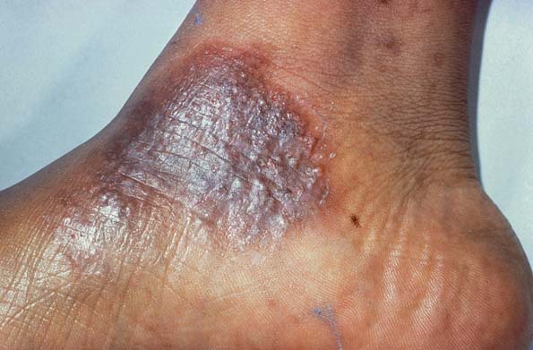 Efflorescenties: de elementen waaruit huidaandoeningen zijn opgebouwd ...