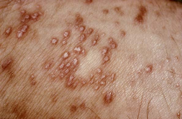 Efflorescenties: de elementen waaruit huidaandoeningen zijn opgebouwd ...