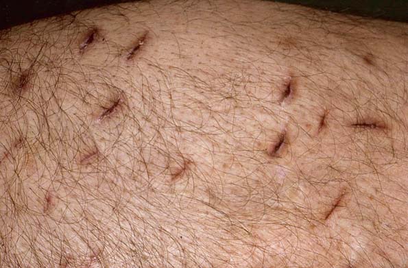 Efflorescenties: de elementen waaruit huidaandoeningen zijn opgebouwd ...