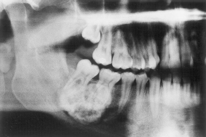 11 Dentogene cysten en tumoren | SpringerLink