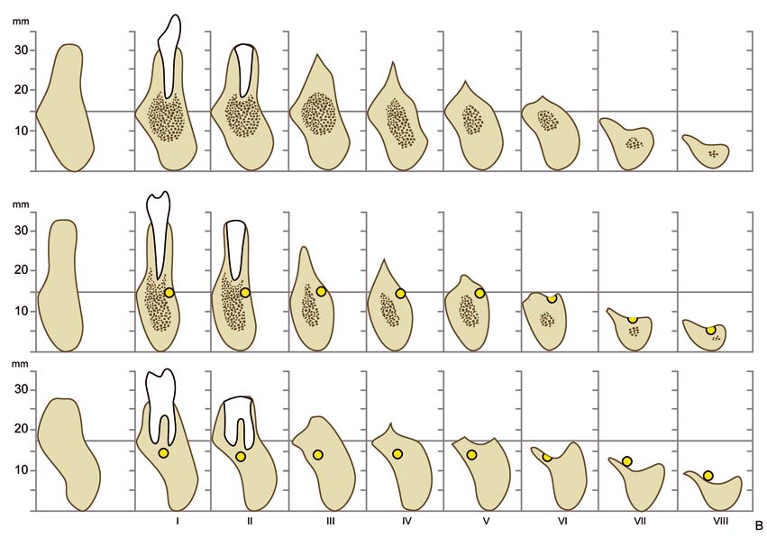 20 Preprothetische en implantologische chirurgie | SpringerLink