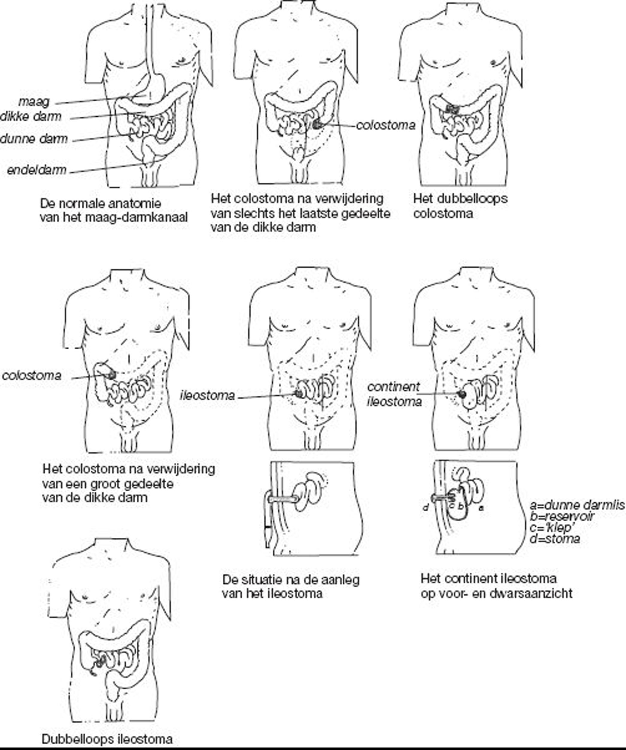 Stoma | SpringerLink