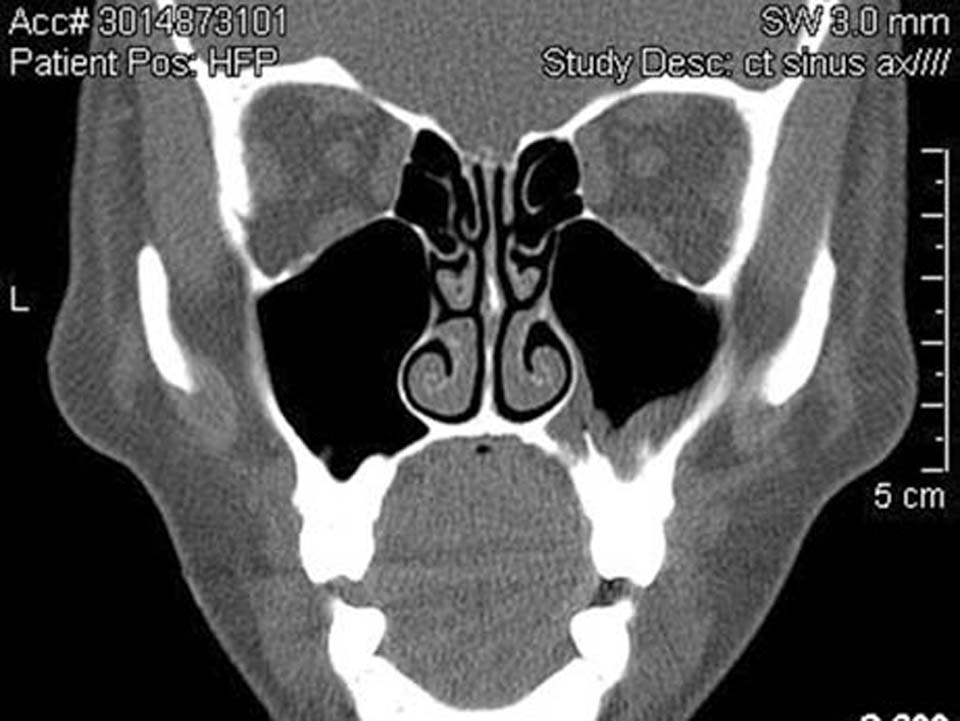 Odontogene en non-odontogene bijholteontstekingen | SpringerLink