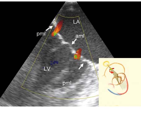 12 De mitralisklep | SpringerLink