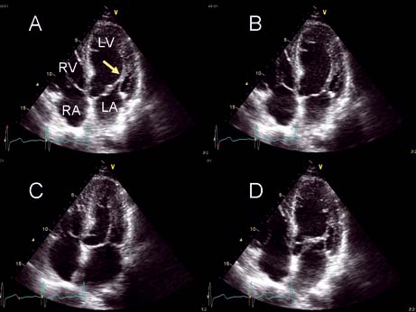 12 De mitralisklep | SpringerLink