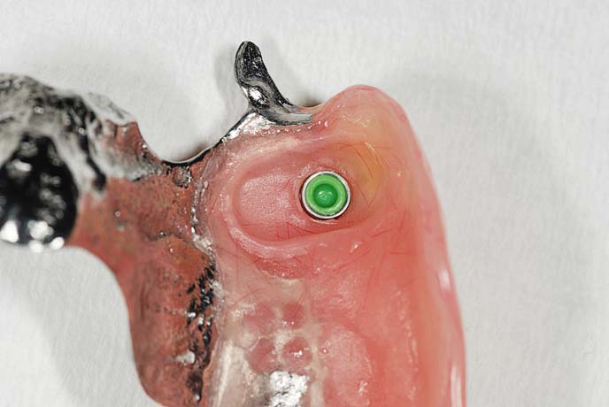 9 (Semi)precisieverankering bij frameprothesen | SpringerLink