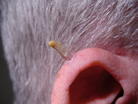 3 Premaligne aandoeningen | SpringerLink