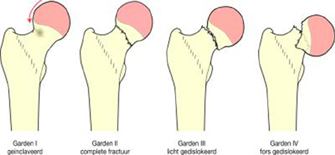 Addendum: heupfracturen | SpringerLink