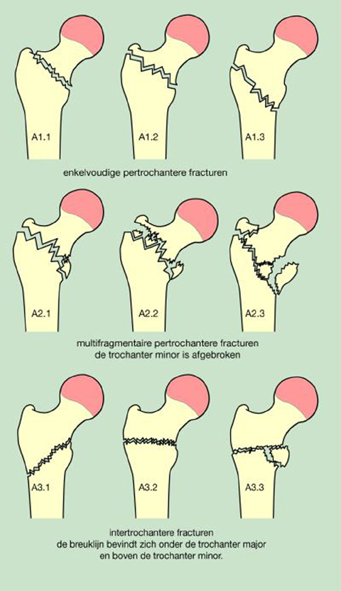 Addendum: heupfracturen | SpringerLink