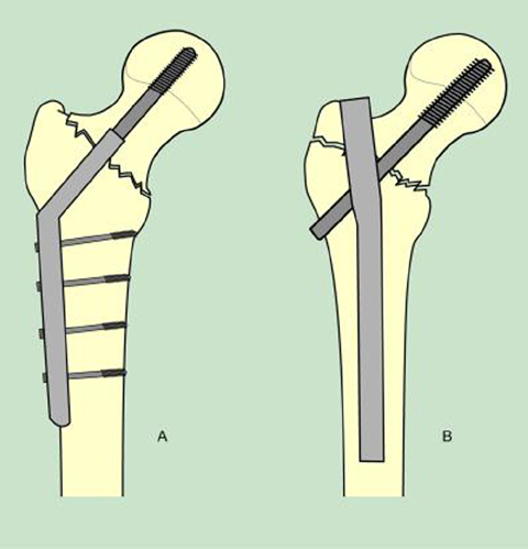 Addendum: heupfracturen | SpringerLink
