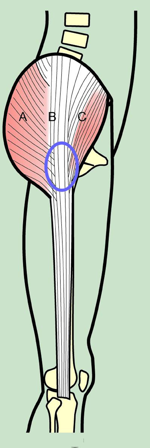 Addendum: tendinose van heupabductoren als oorzaak van het trochanter major pijnsyndroom ...