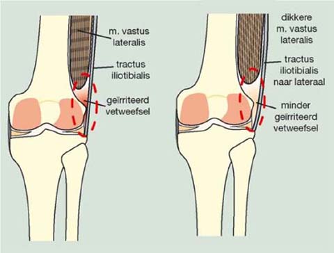 Addendum: het tractus iliotibialis frictiesyndroom tractus iliotibialis ...