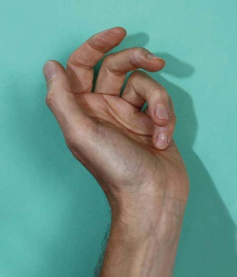 Motorische uitval bij zenuwletsel | SpringerLink