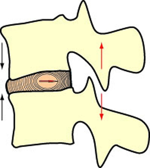 Addendum: discusdegeneratie van de lumbale wervelkolom | SpringerLink