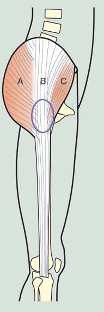 Addendum: tendinose van heupabductoren als oorzaak van het trochanter ...