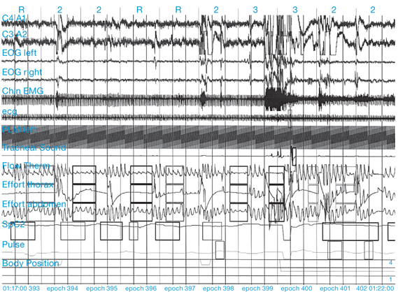 10 Polysomnografie | SpringerLink