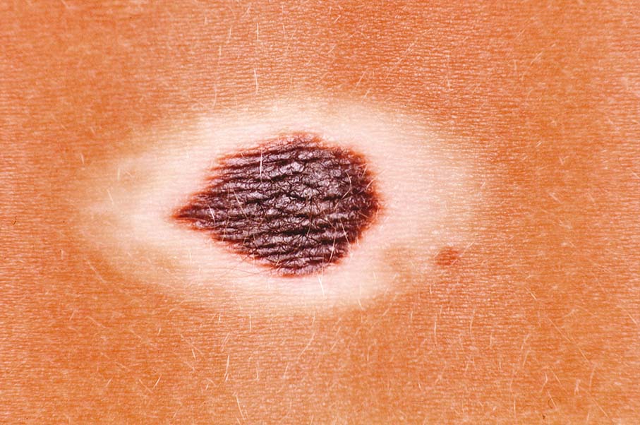 14 Benigne huidtumoren | SpringerLink