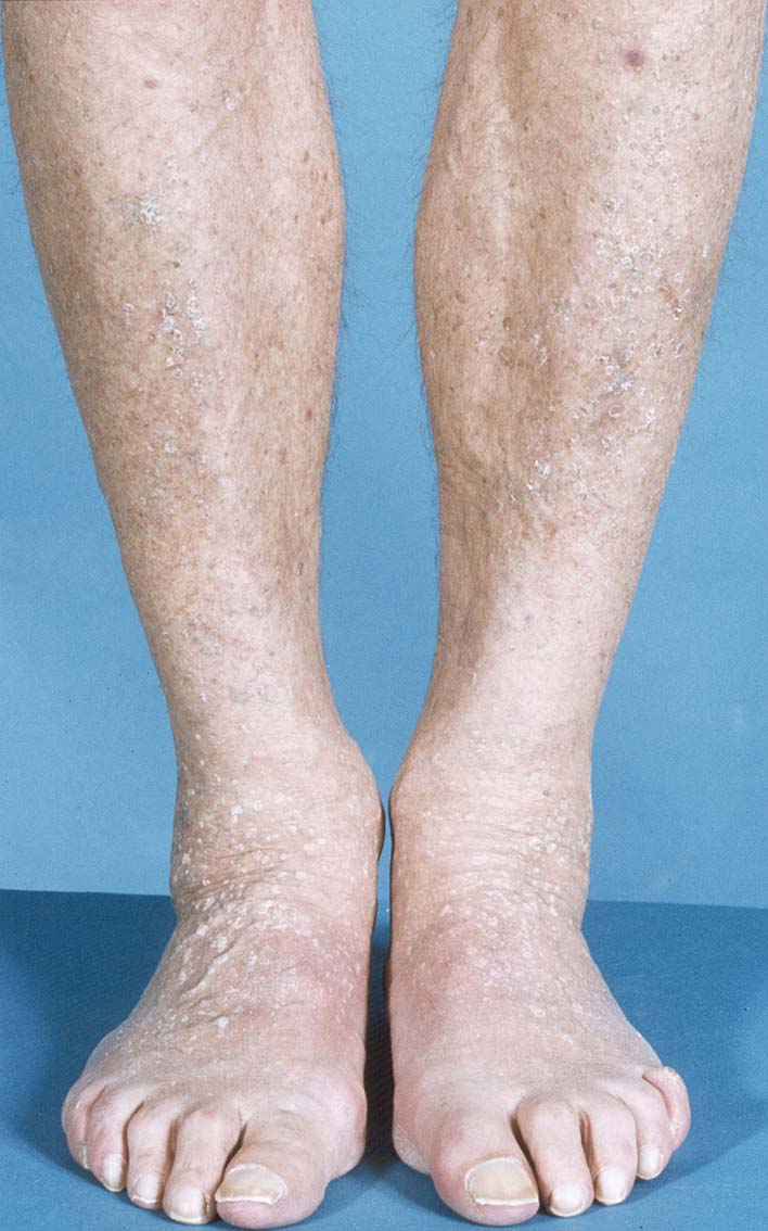 14 Benigne huidtumoren | SpringerLink