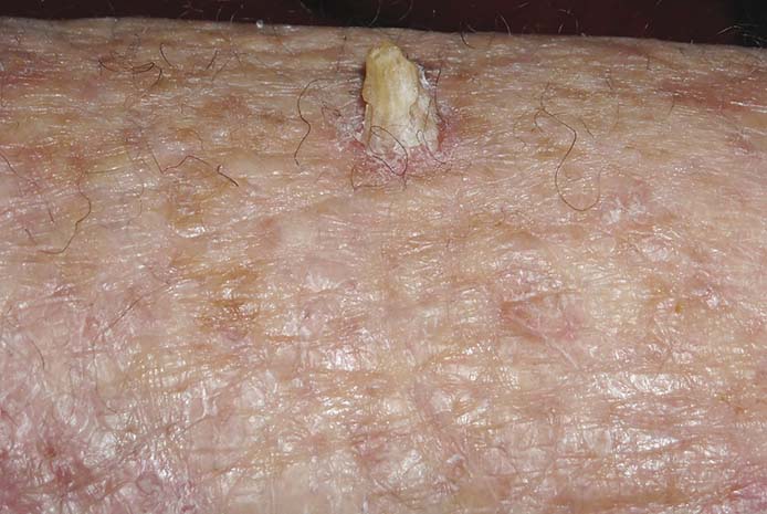 15 Premaligne en maligne huidtumoren | SpringerLink