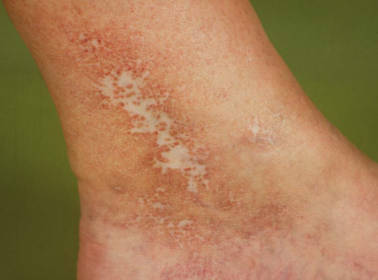 18 Ulcus cruris, decubitus en andere ulcereuze dermatosen | SpringerLink