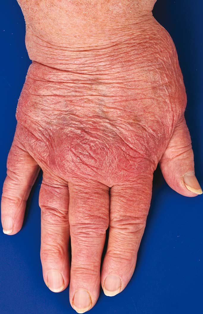 6 Erythemateuze dermatosen | SpringerLink