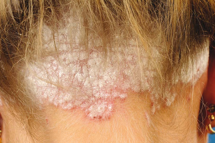 8 Psoriasis en andere erythematosquameuze dermatosen | SpringerLink